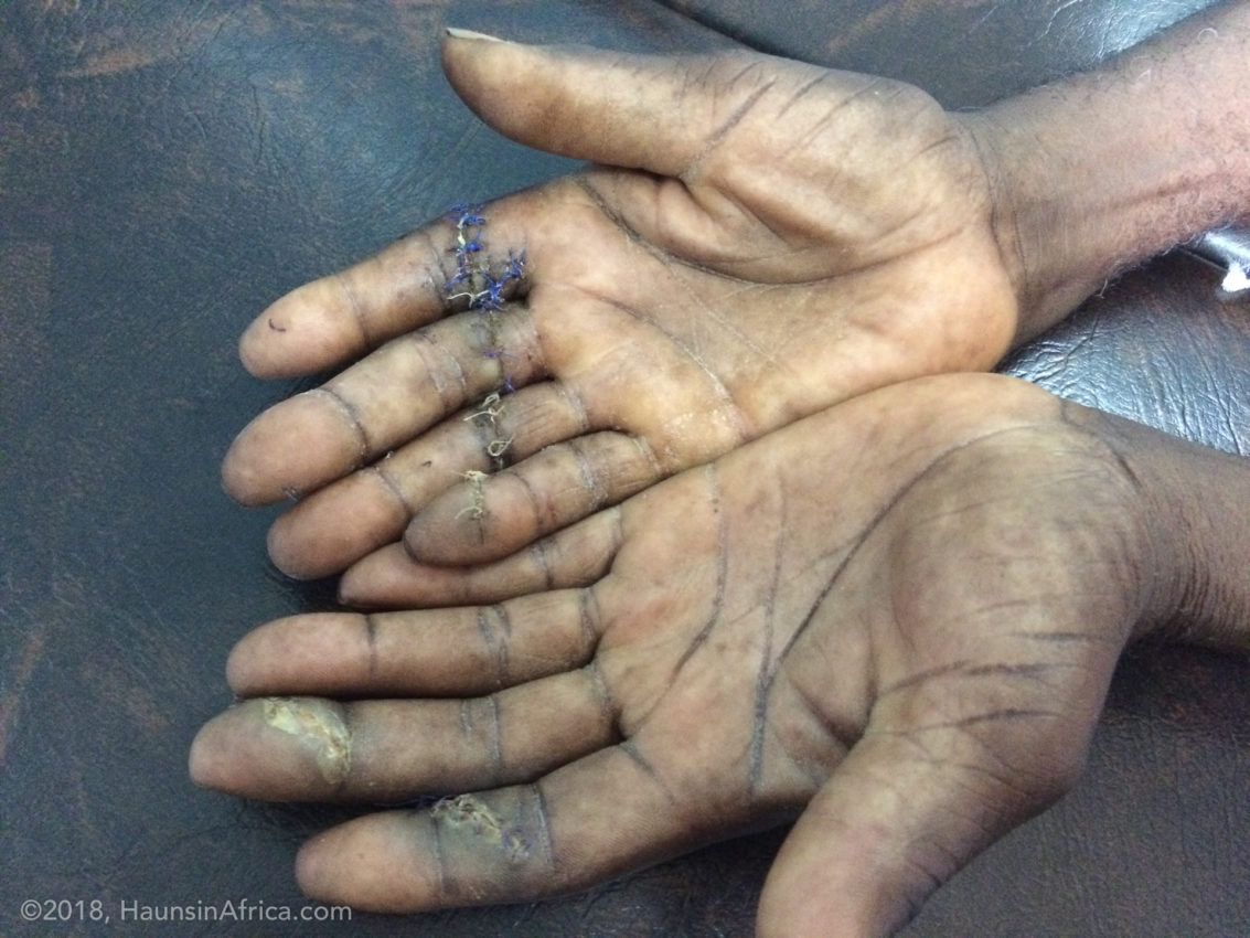 Hand Tendon Injuries and Repair - The Hauns in Africa