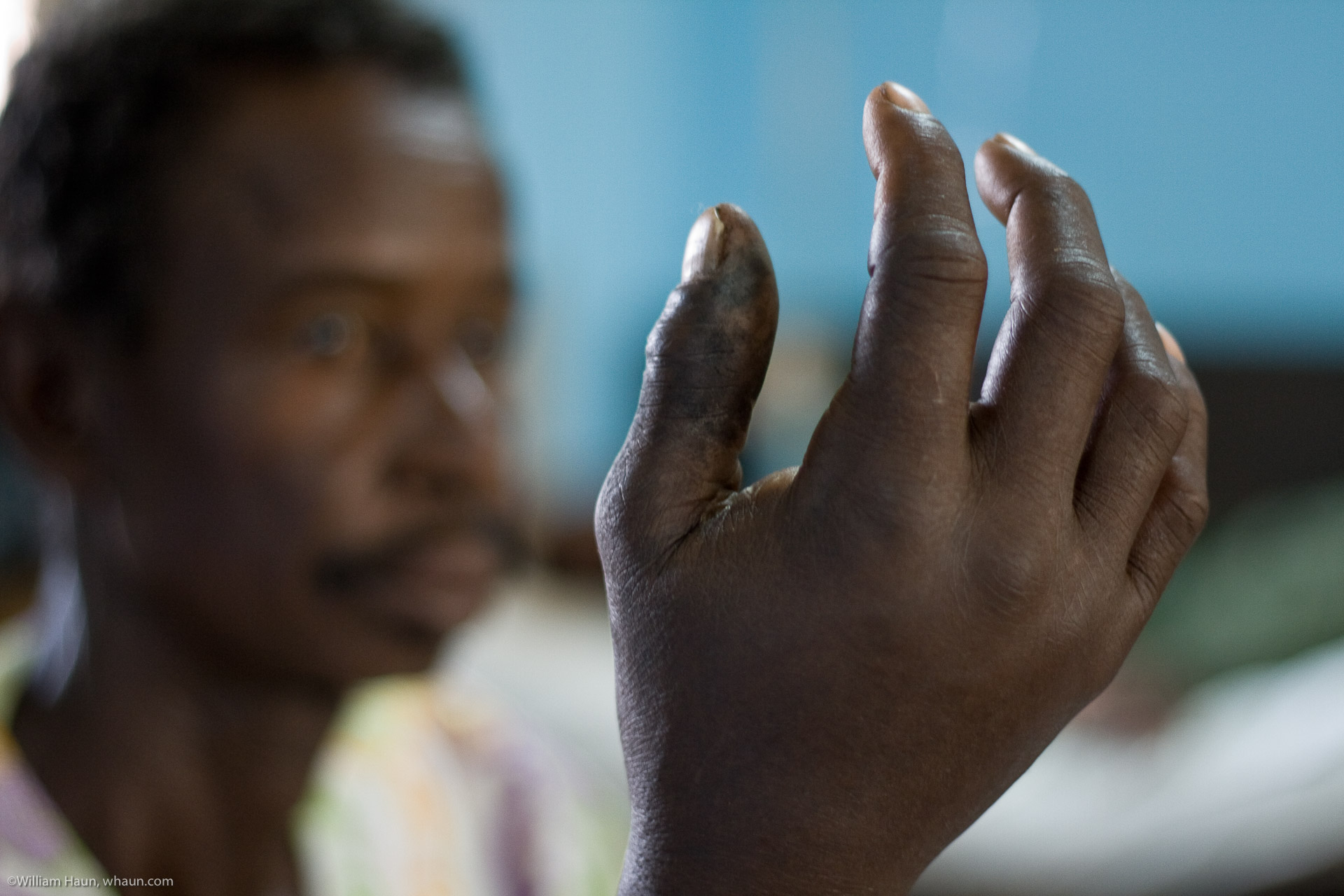 Snake Bites in Northern Ghana - The Hauns in Africa
