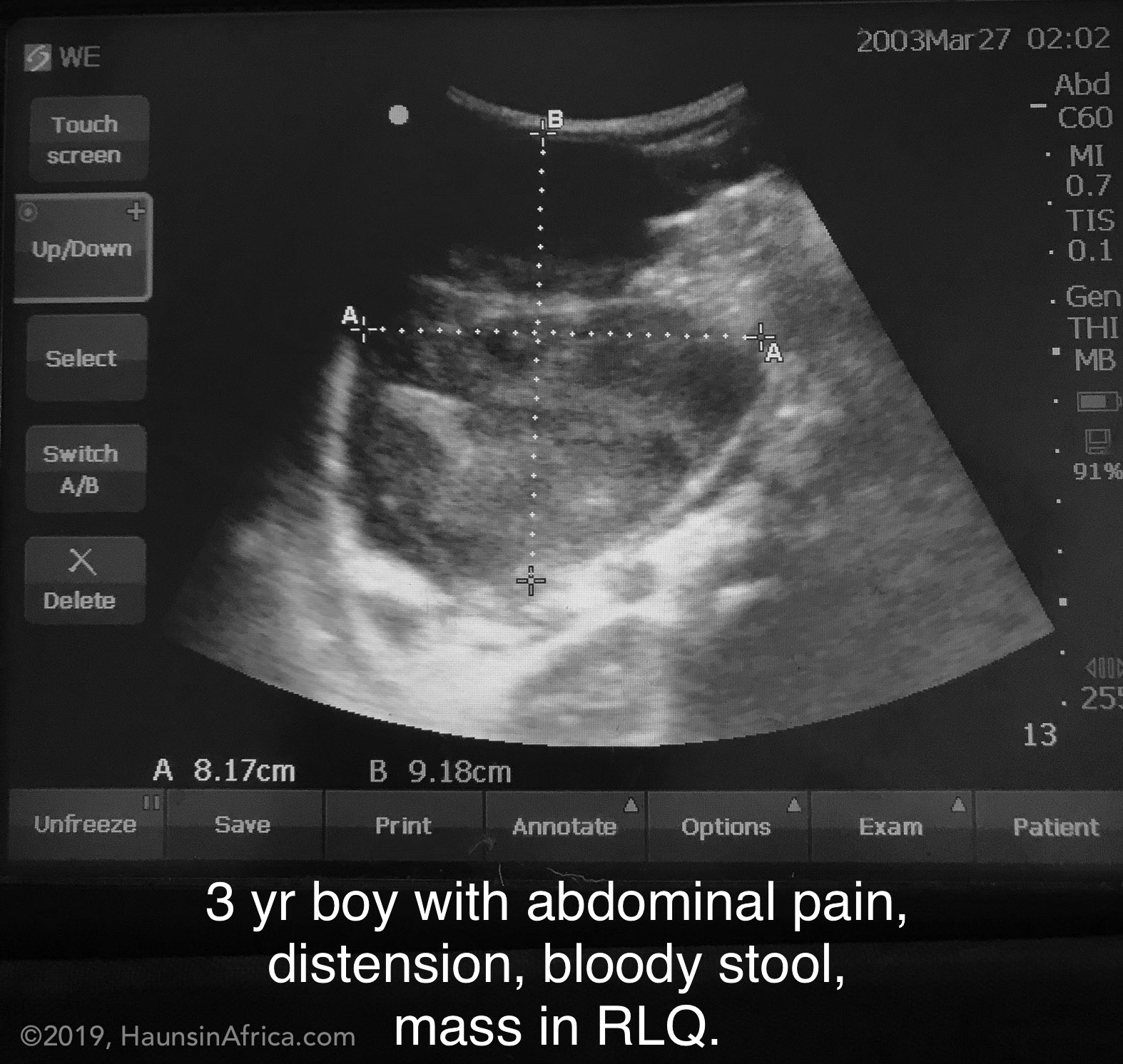 Burkitt's Lymphoma Removal & Bowel Resection - The Hauns in Africa