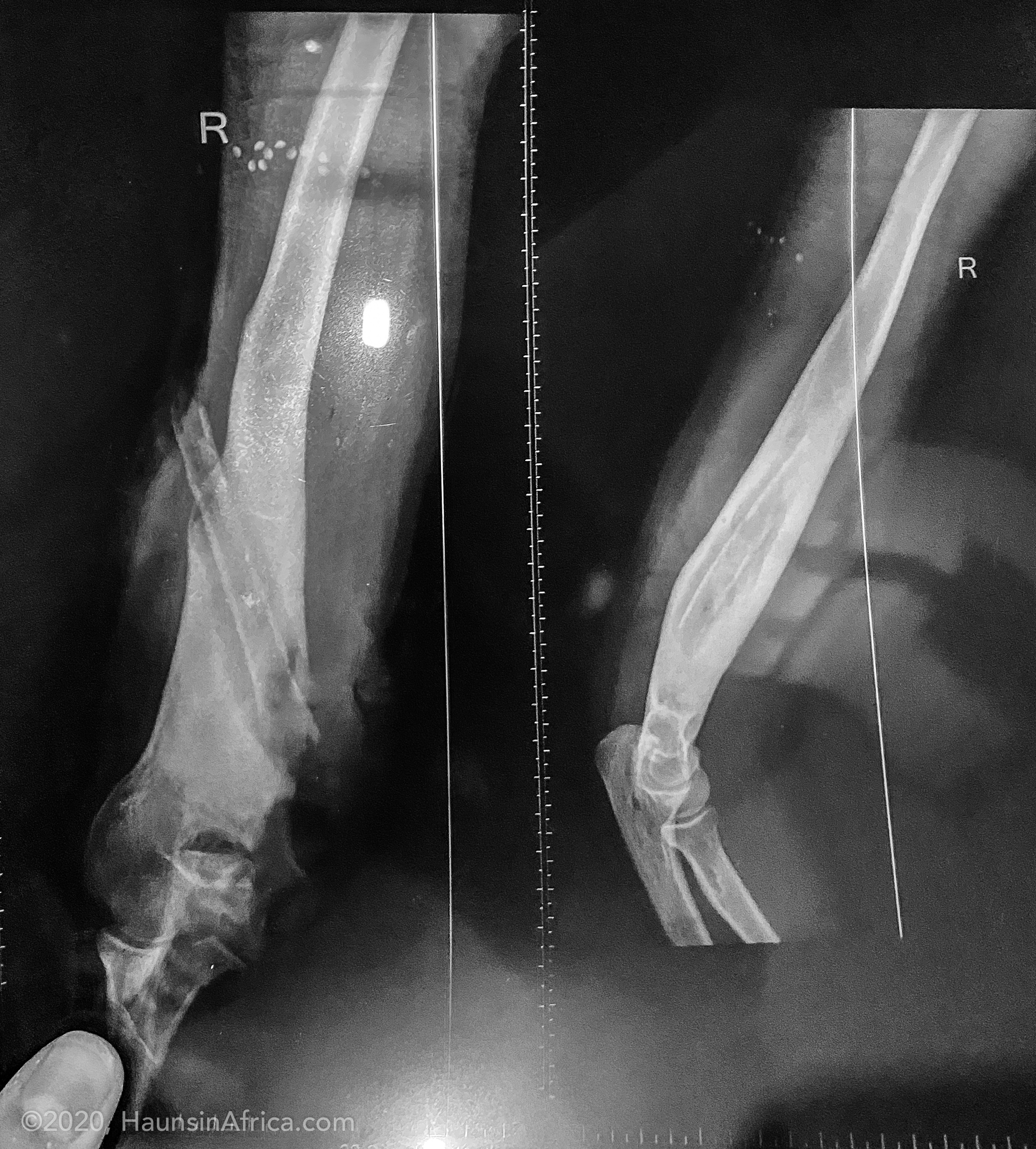 Right Humerus Sequestrectomy - The Hauns in Africa