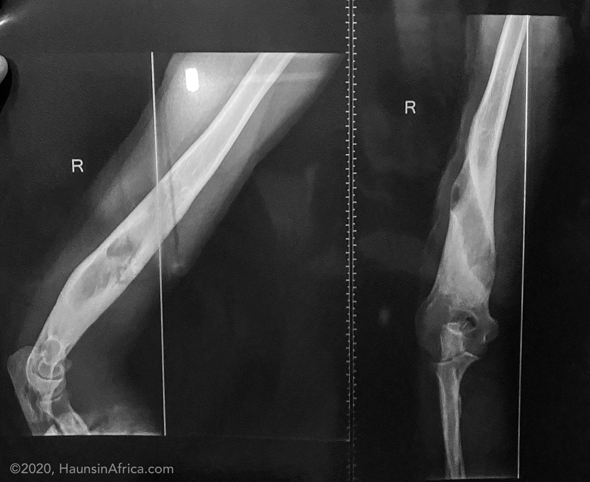 Right Humerus Sequestrectomy - The Hauns in Africa
