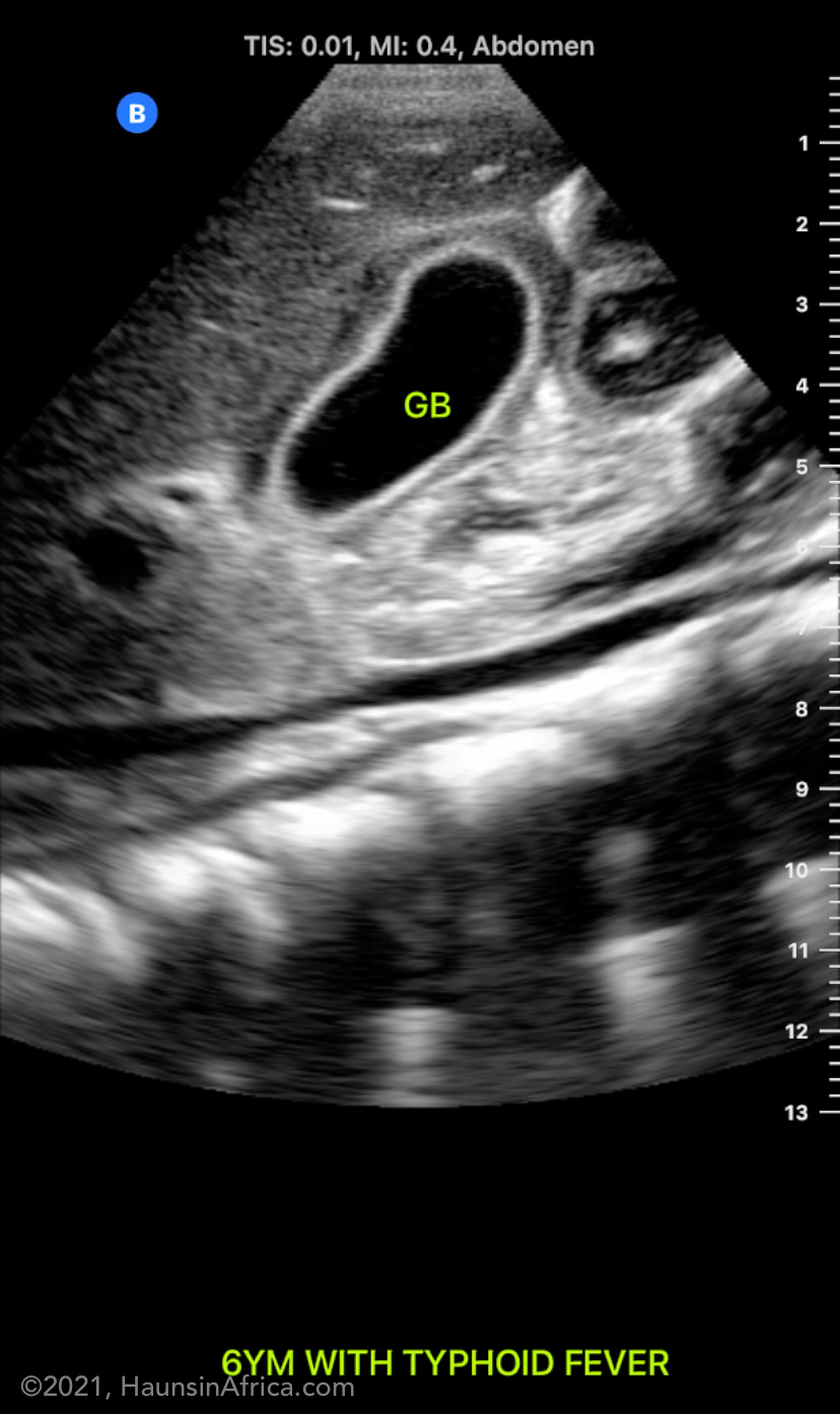 Gross Gangrene Gallbladders Galore! - The Hauns in Africa