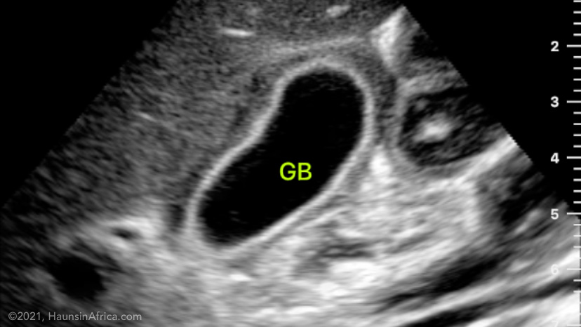 Gross Gangrene Gallbladders Galore! - The Hauns in Africa