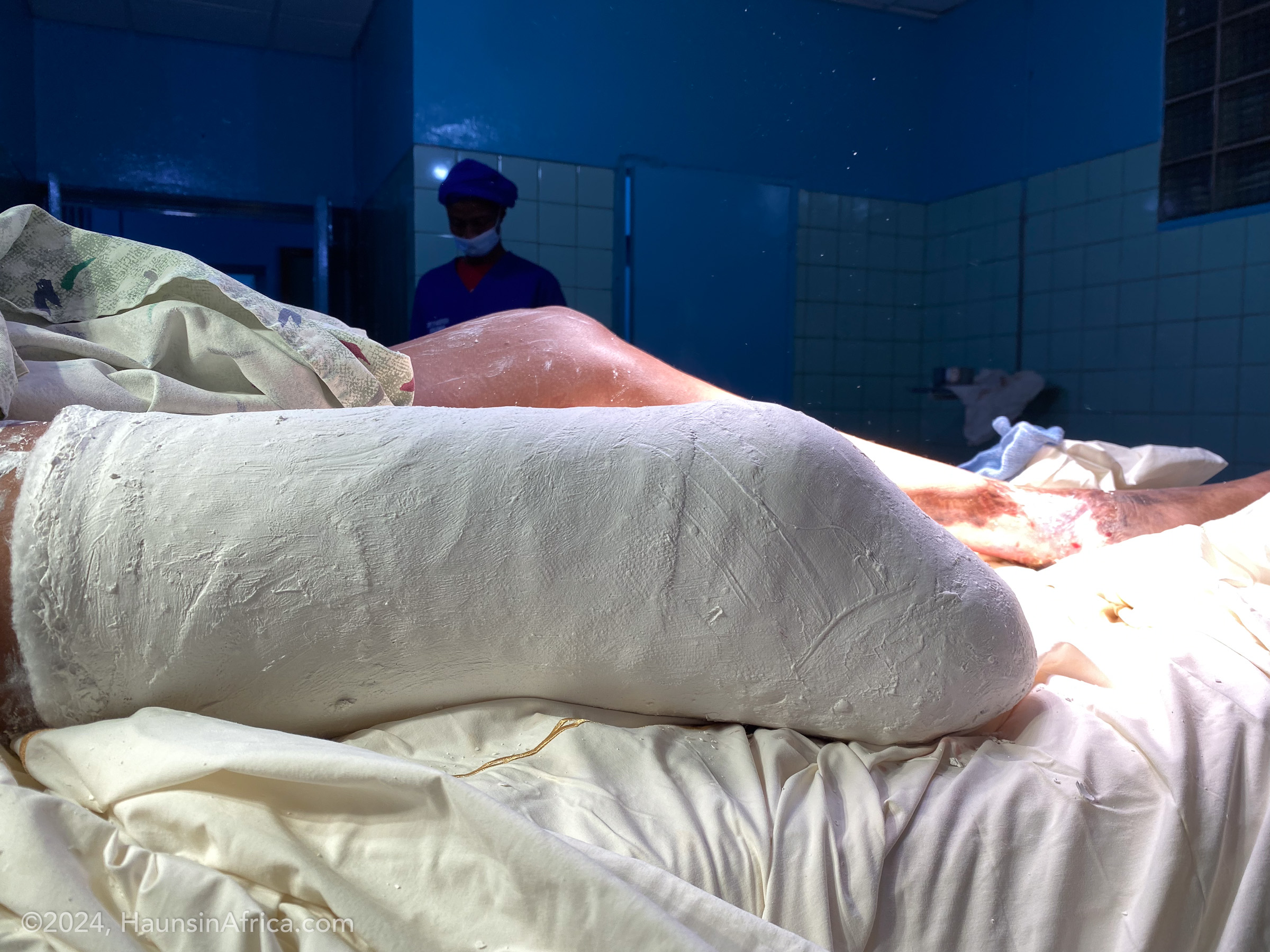 Autoamputation - Learning to walk again - The Hauns in Africa