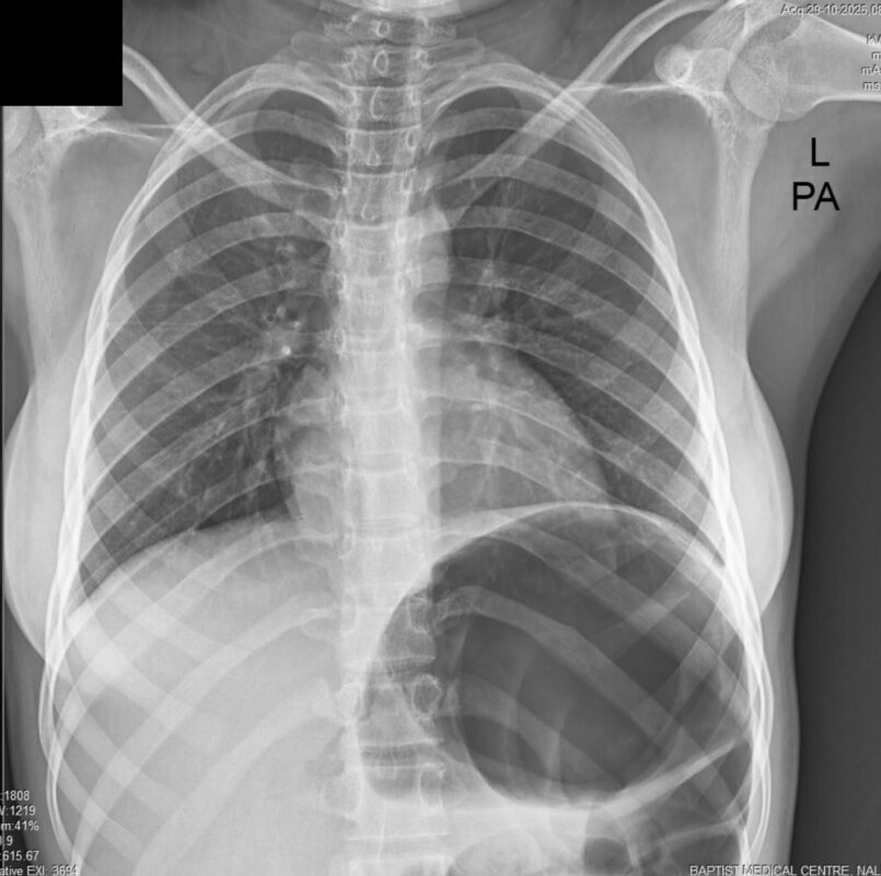 Cecal Volvulus - The Hauns in Africa